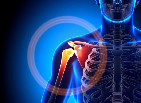 Síndrome Subacromial - Fisioterapia en Forma